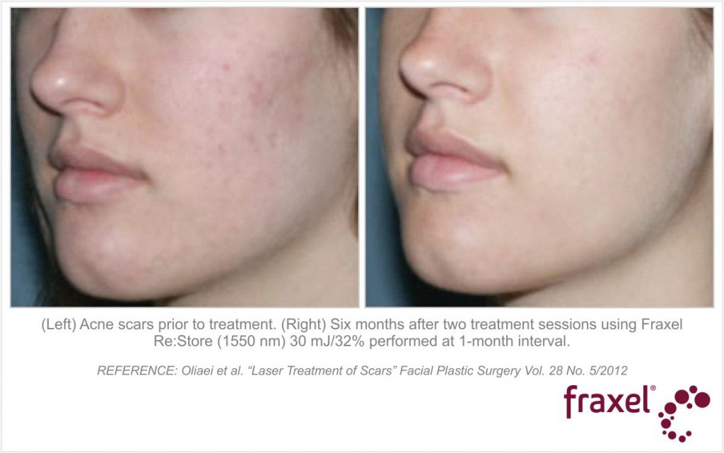 Fraxel Results - Fraxel